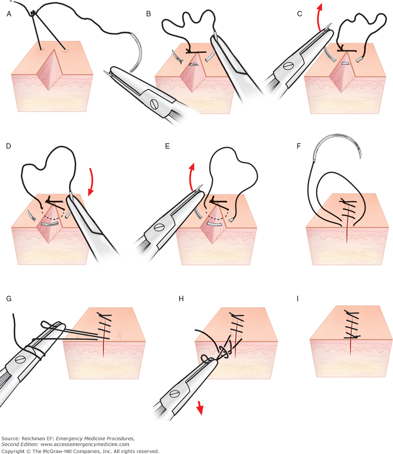 Laceration Repair Guide To YKHC Medical Practices