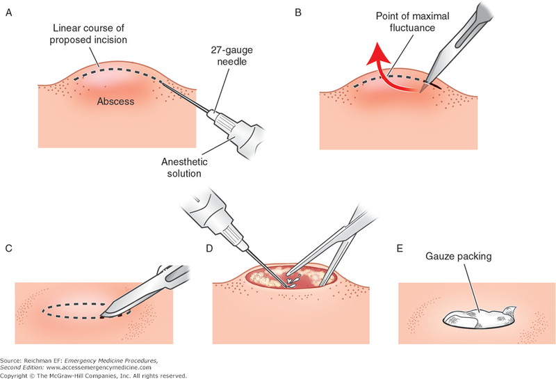 Abscess Incision And Drainage I D Guide To YKHC Medical Practices
